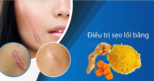 Cách trị sẹo lồi an toàn hiệu quả nhanh nhất