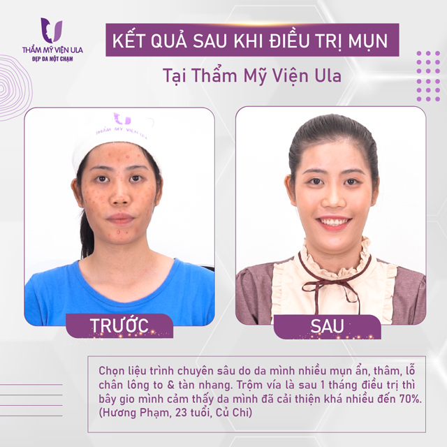 Thẩm mỹ viện trị mụn Ula Spa giúp nàng sở hữu làn da sáng mịn chuẩn sao Hàn