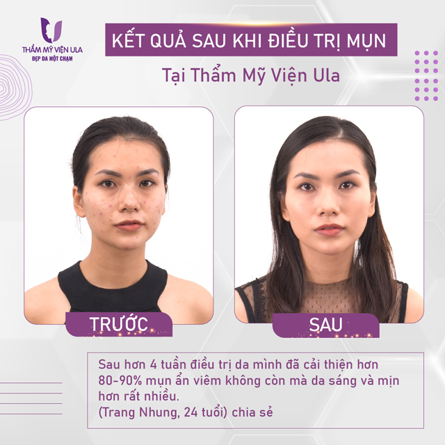 Thẩm mỹ viện trị mụn Ula Spa giúp nàng sở hữu làn da sáng mịn chuẩn sao Hàn